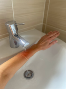 Head Bumps: When to Worry and What to Do | First Class First Aid