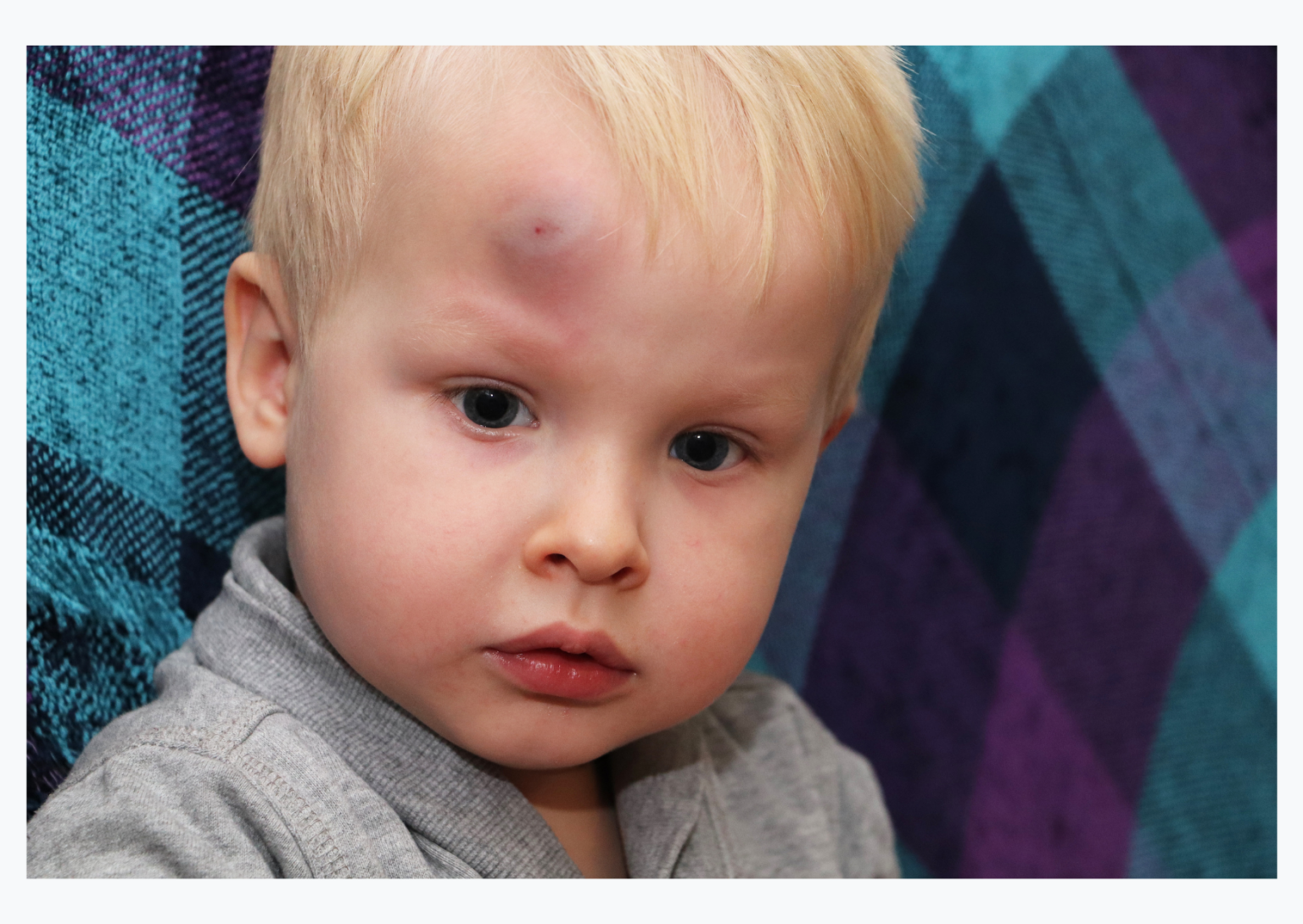 Head Bumps: When to Worry and What to Do | First Class First Aid